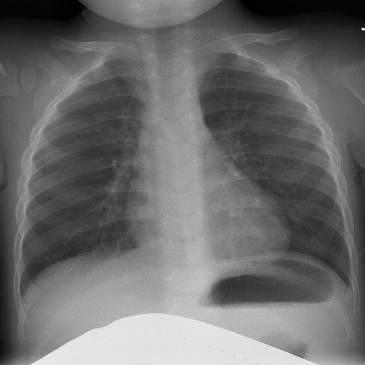 Bronchiolitis and acute pediatric pneumonia