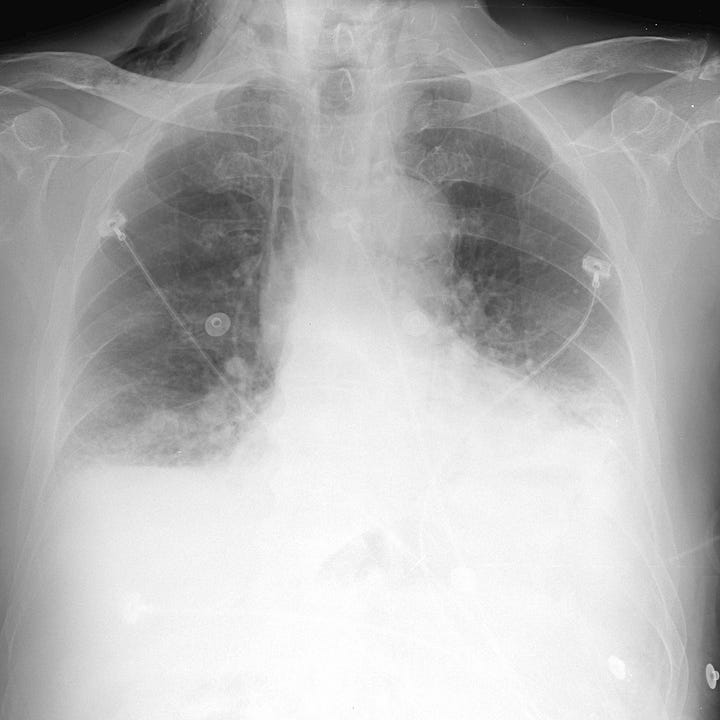 Boerhaave syndrome - by Alexander Baxter - RadNotes