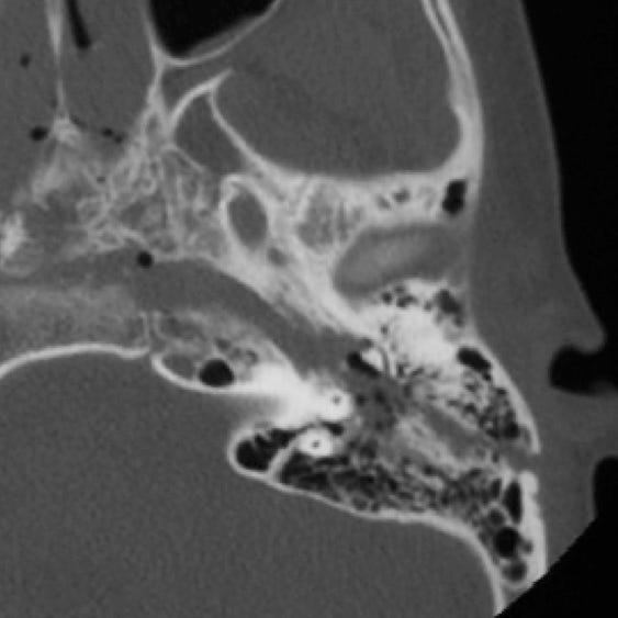 Temporal bone fracture - by Alexander Baxter - RadNotes