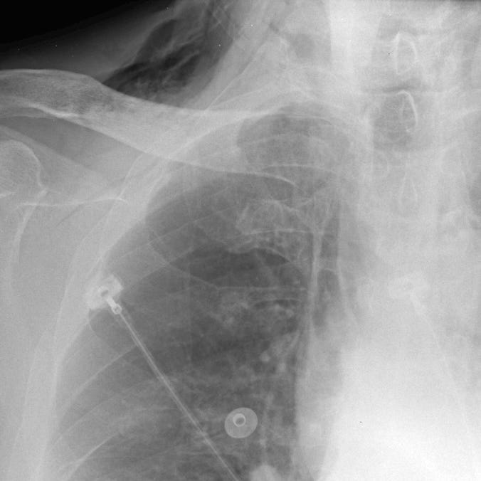 Boerhaave syndrome - by Alexander Baxter - RadNotes