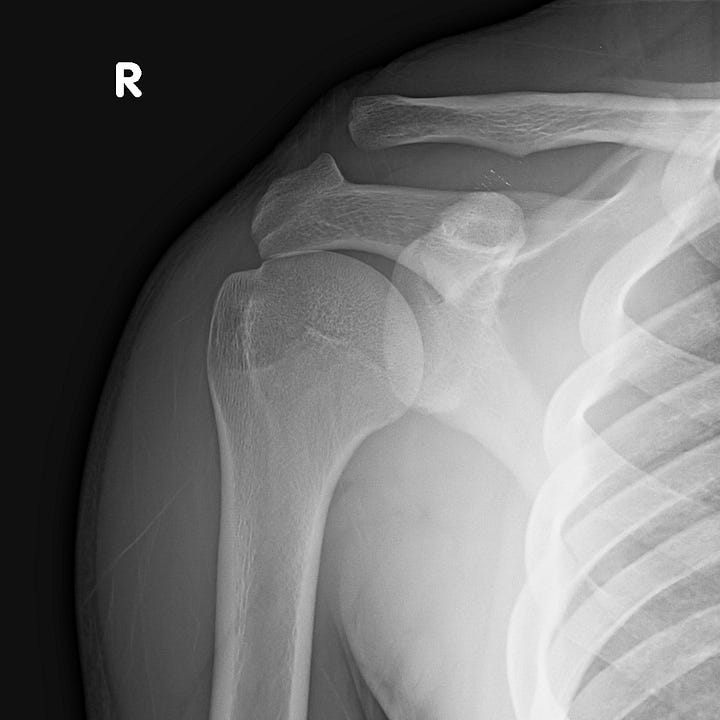 Acromioclavicular separation - by Alexander Baxter
