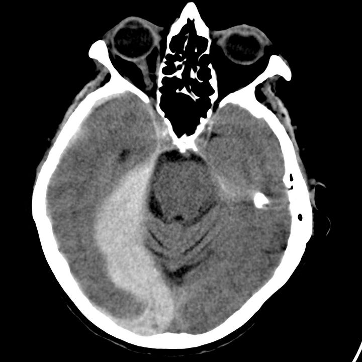 Acute Subdural Hematoma - by Alexander Baxter - RadNotes