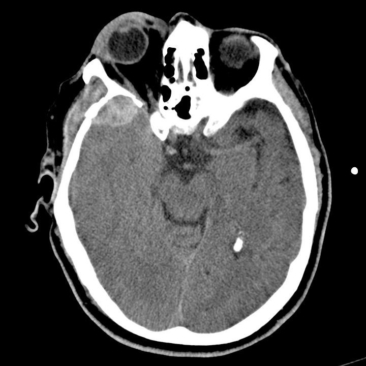 Epidural Hematoma - by Alexander Baxter - RadNotes