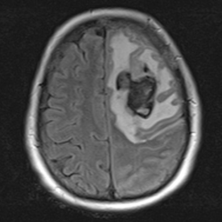 Cerebral edema patterns - RadNotes