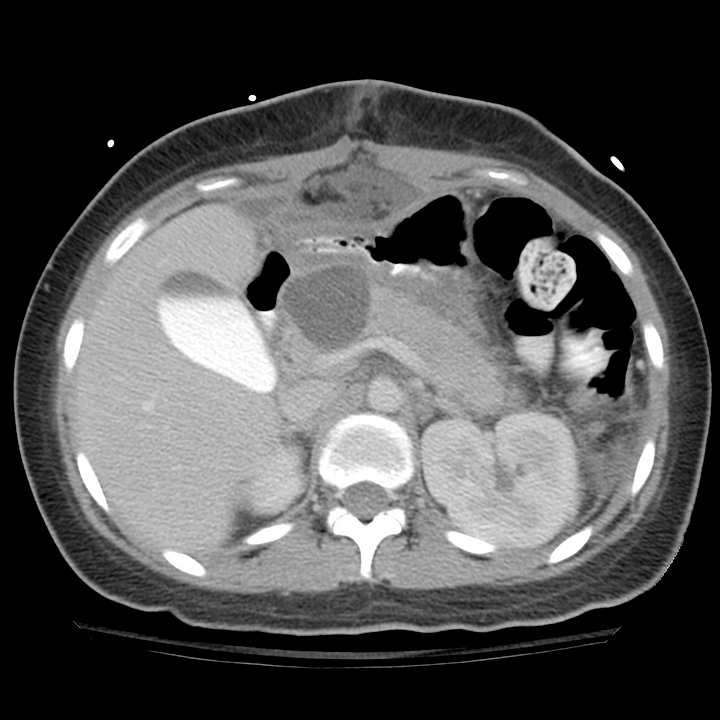 Traumatic Pancreatic Injury - by Alexander Baxter
