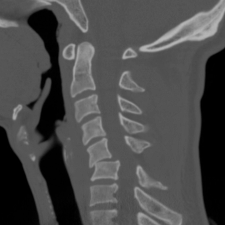 Cervical Spine Hyperflexion Injuries - by Alexander Baxter
