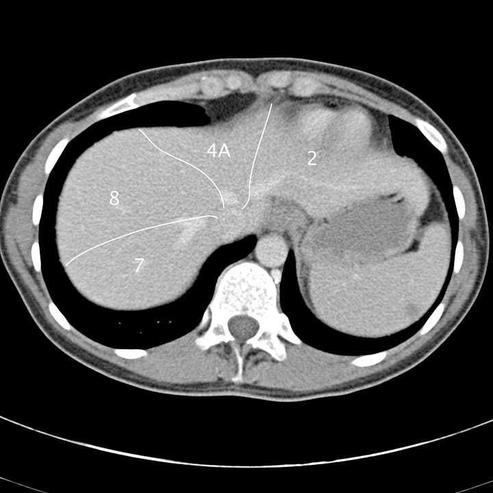 Hepatic segmental anatomy - by Alexander Baxter - RadNotes