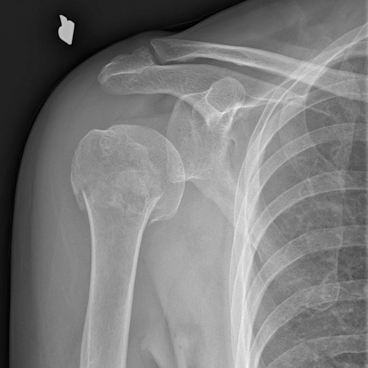 Humeral head and neck fractures - by Alexander Baxter