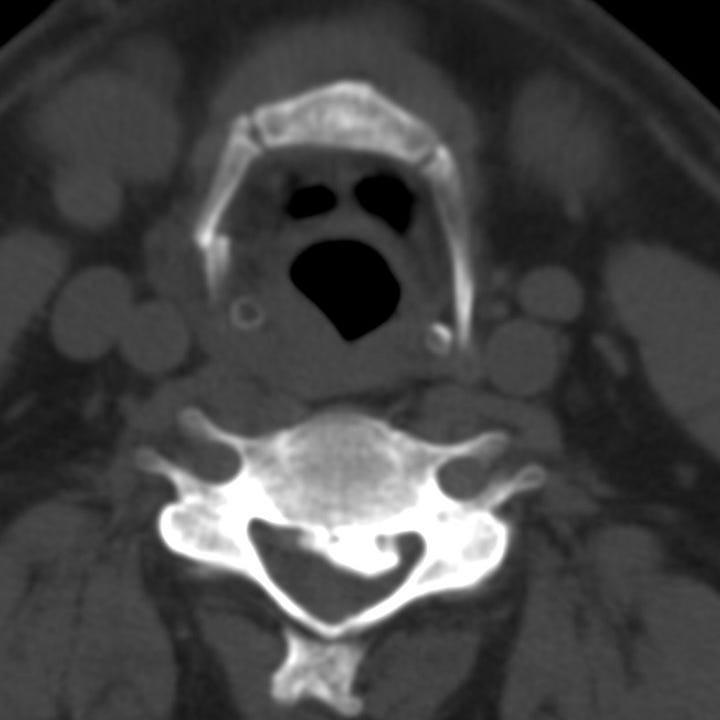 Laryngeal fracture - by Alexander Baxter - RadNotes