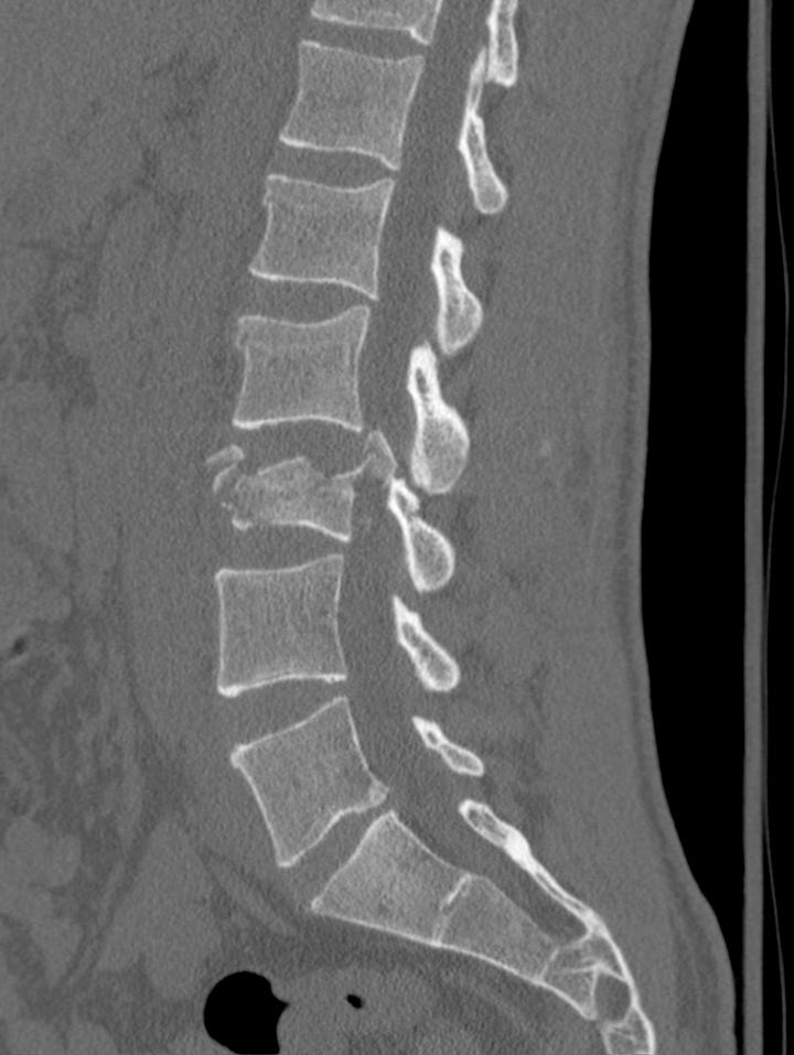 Vertebral compression fractures - by Alexander Baxter