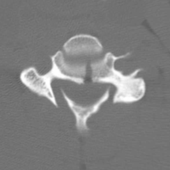 Cervical Spine Hyperflexion Injuries - by Alexander Baxter