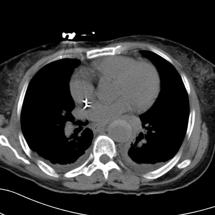 Aortic dissection and non traumatic aortic rupture