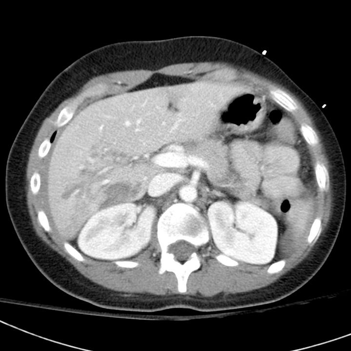 Hepatic injury - by Alexander Baxter - RadNotes