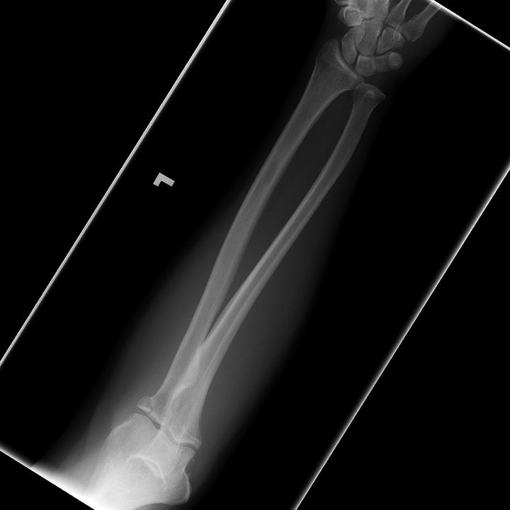 Radial head fracture and Essex-Lopresti fracture dislocation