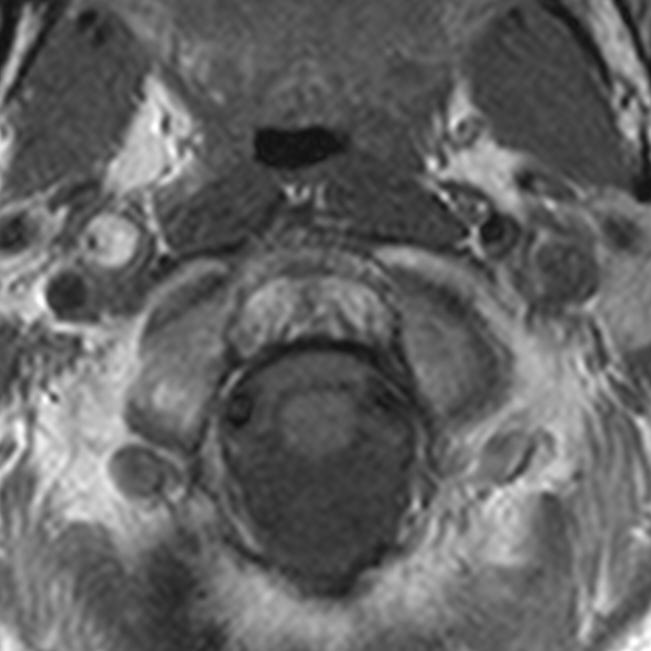 Cervical vascular injury - by Alexander Baxter - RadNotes