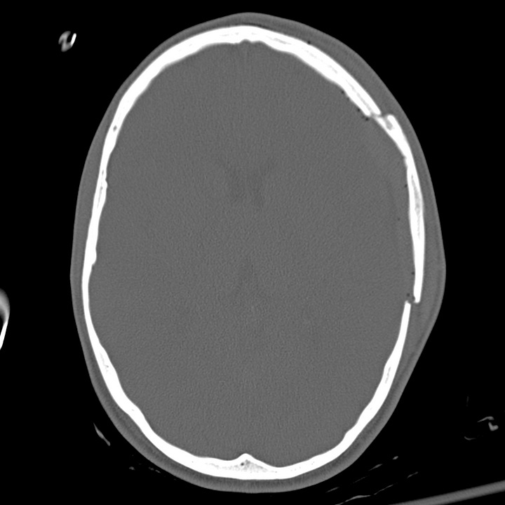 Skull fracture - by Alexander Baxter - RadNotes