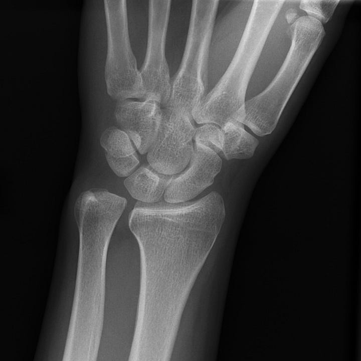 Radial head fracture and Essex-Lopresti fracture dislocation