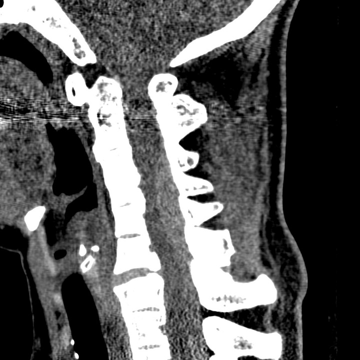 Spinal epidural hematoma - by Alexander Baxter - RadNotes