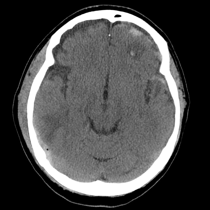 Subdural hygroma - by Alexander Baxter - RadNotes