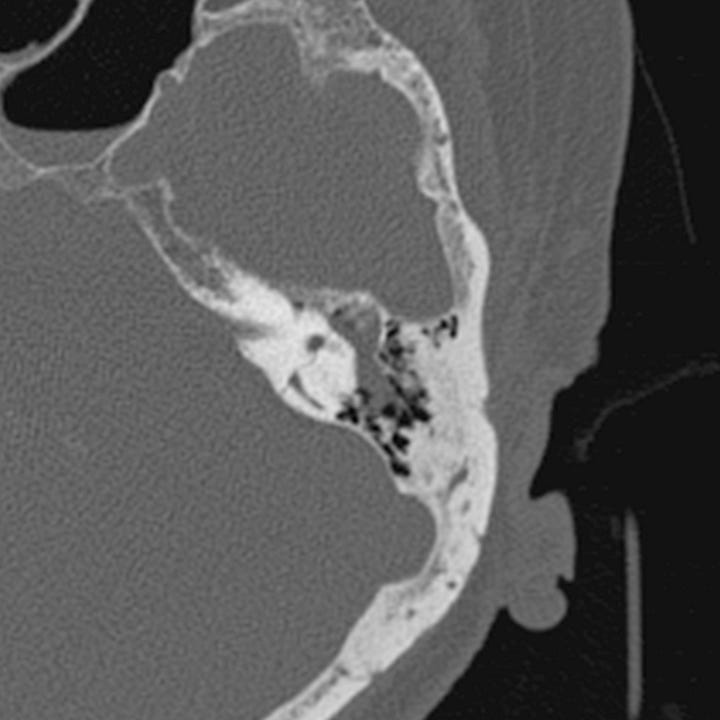 Temporal bone fracture - by Alexander Baxter - RadNotes