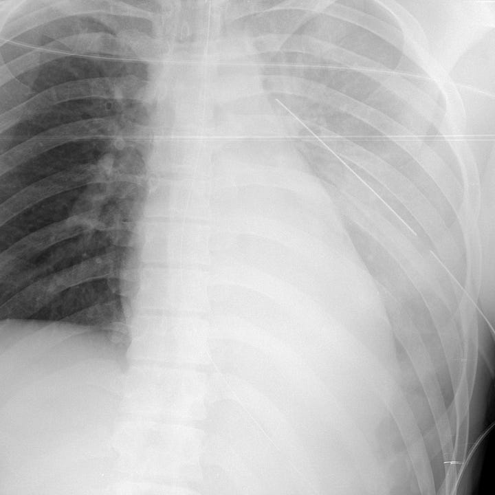 Traumatic hemothorax - RadNotes