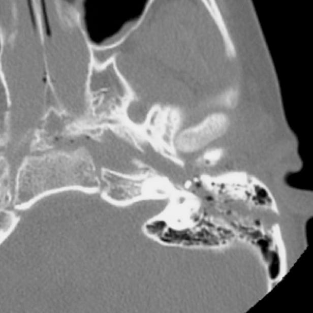 Temporal bone fracture - by Alexander Baxter - RadNotes