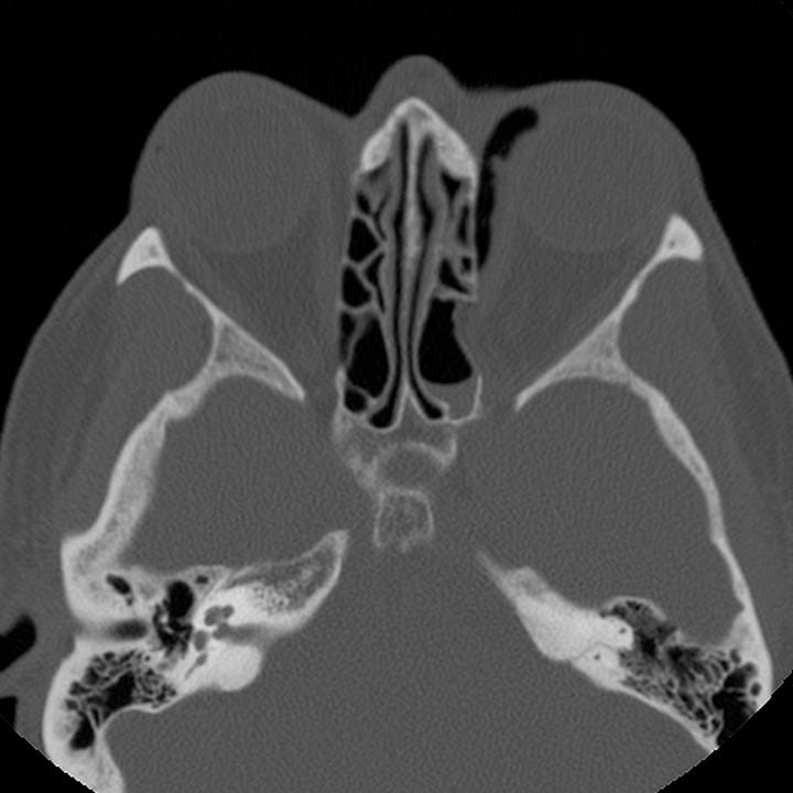 Orbital wall fractures - by Alexander Baxter - RadNotes
