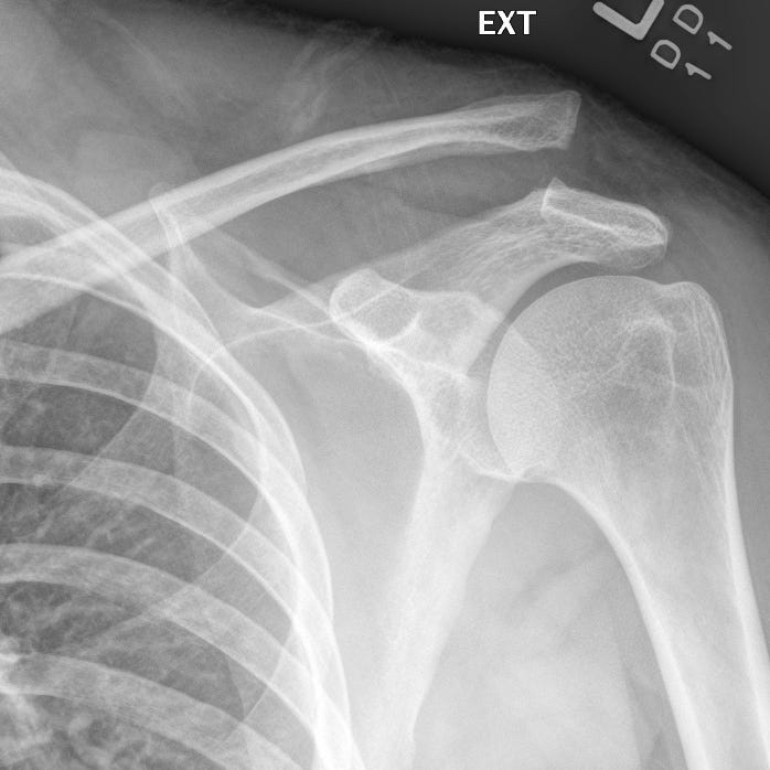 Acromioclavicular separation - by Alexander Baxter