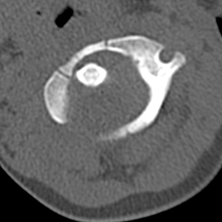 Atlantoaxial rotatory subluxation - by Alexander Baxter