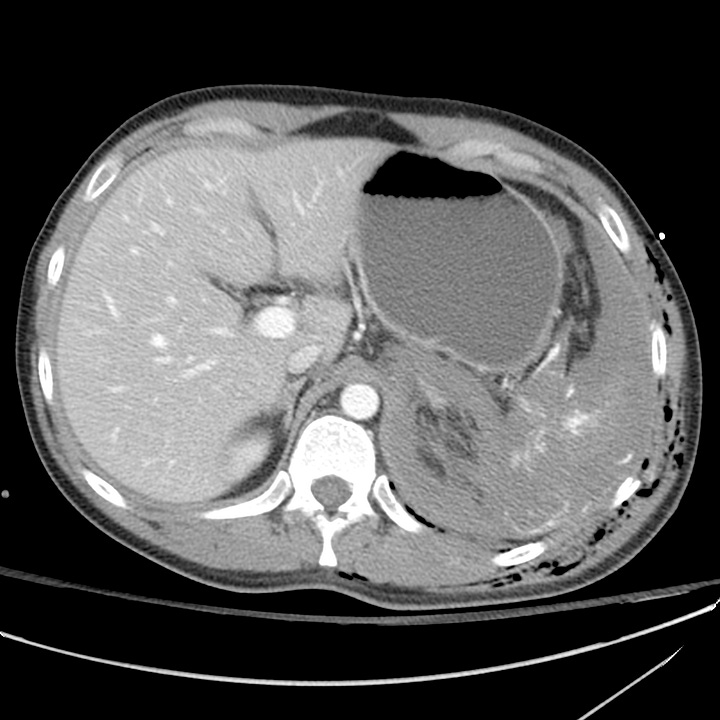 Splenic Injury - by Alexander Baxter - RadNotes
