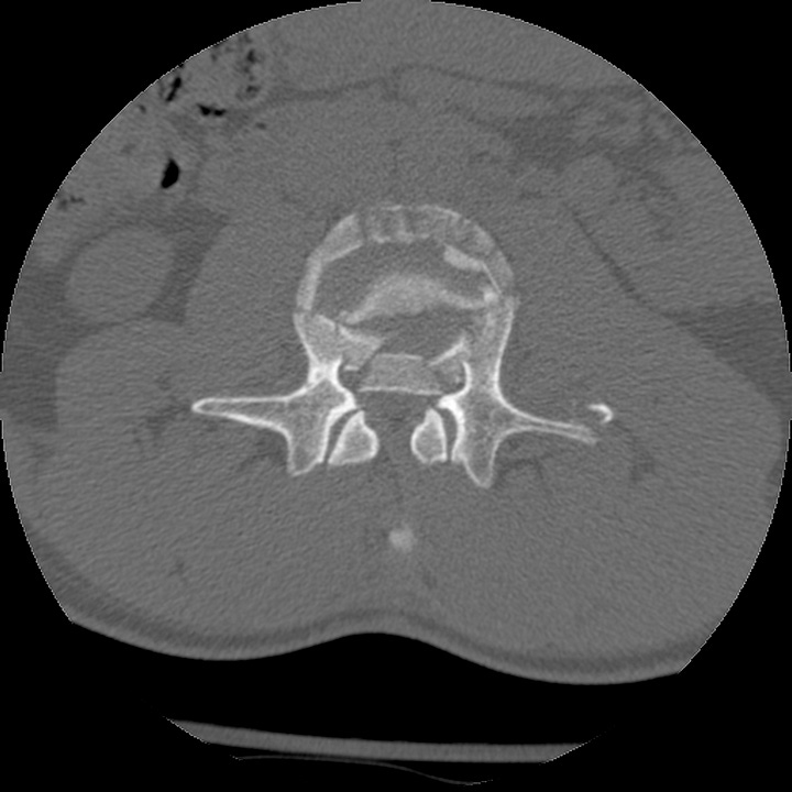Vertebral compression fractures - by Alexander Baxter