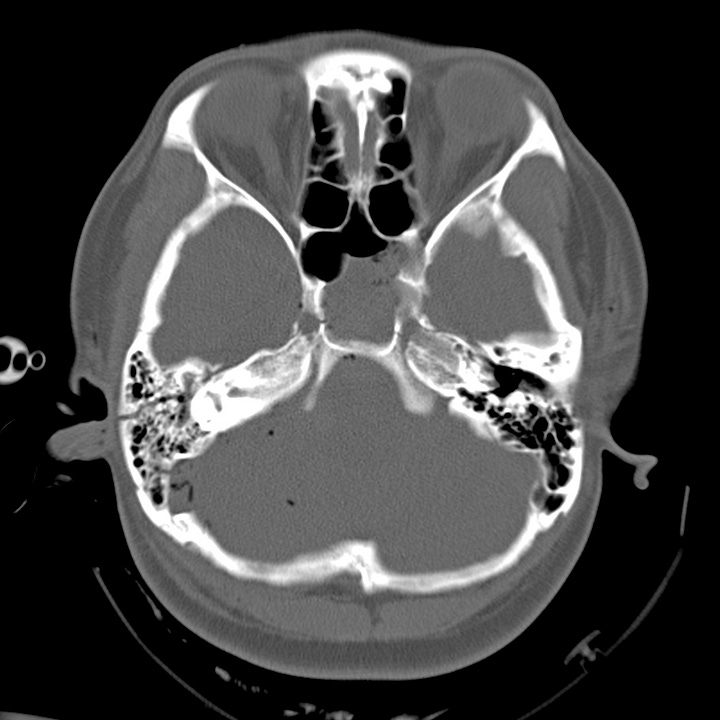 Skull fracture - by Alexander Baxter - RadNotes