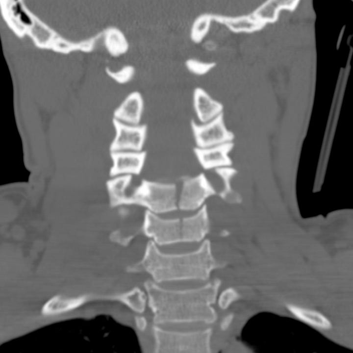 Cervical Spine Hyperflexion Injuries - by Alexander Baxter