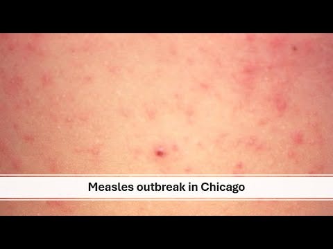 Chicago measles outbreak update (Video News Report)